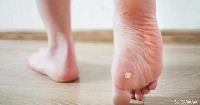 ما هو الثالول الجلدي؟ | سوبر ماما